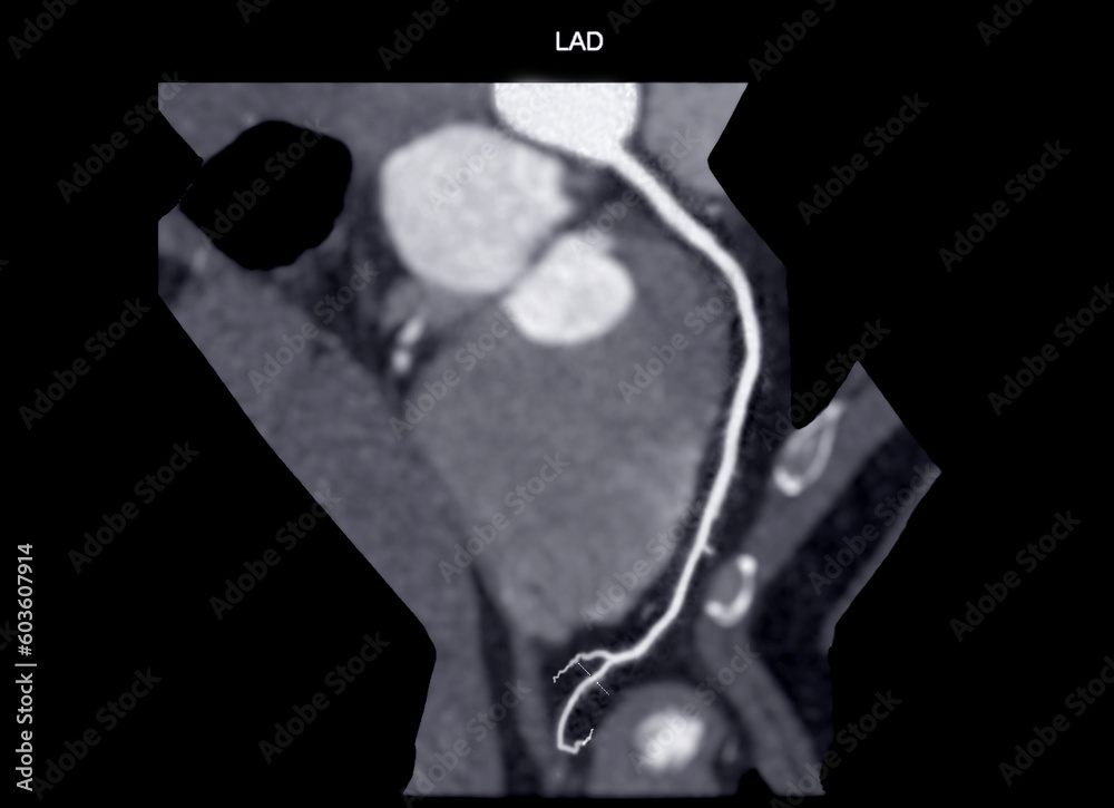 CTA coronary artery Curve refomation showing left coronary artery ...