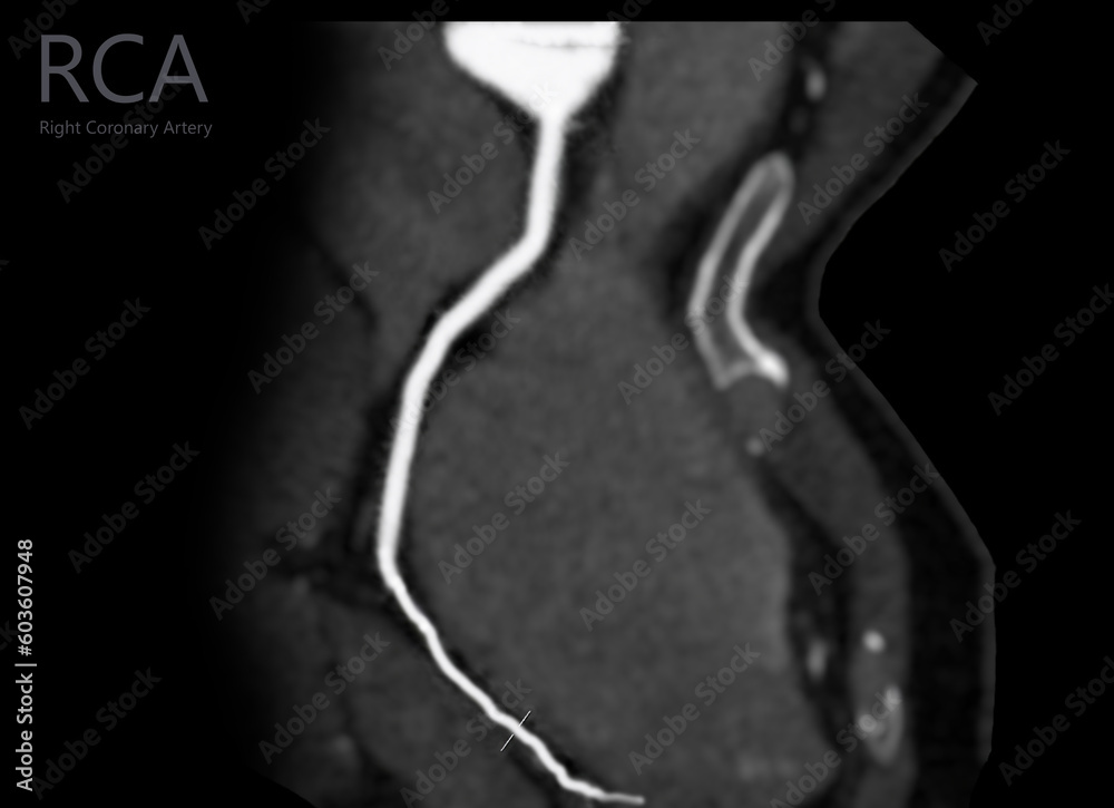 CTA coronary artery Curve refomation showing Right coronary artery ...
