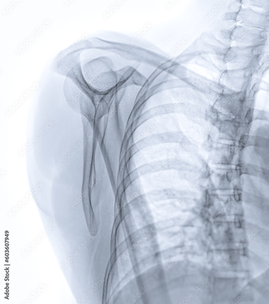 X-ray of Shoulder joint transcapula view showing normal scapula bone ...