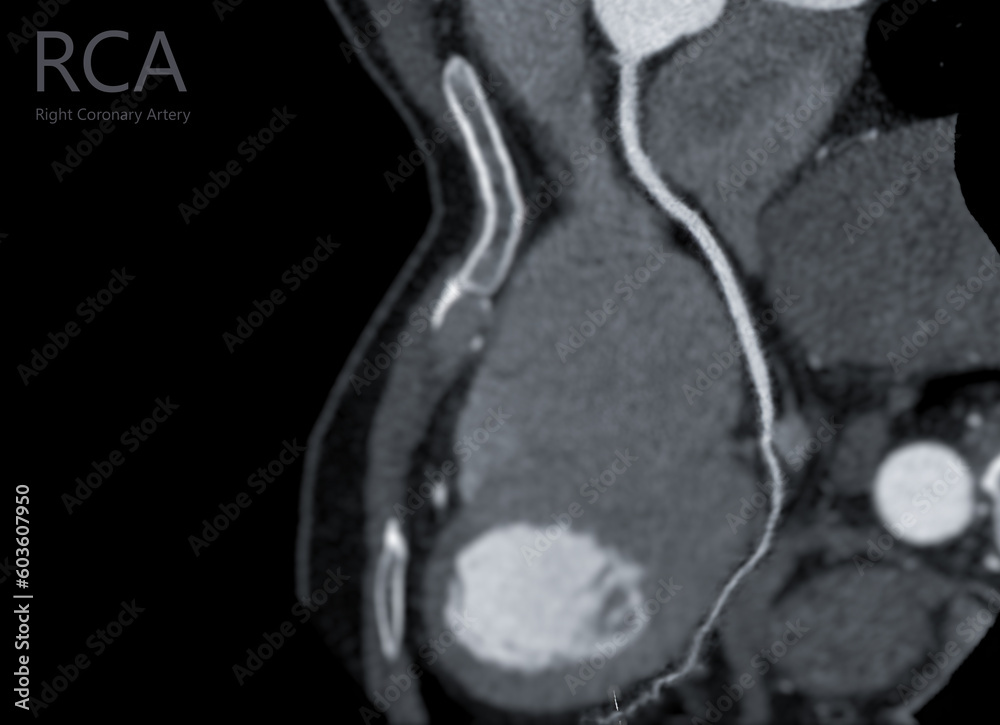 CTA coronary artery Curve refomation showing Right coronary artery ...