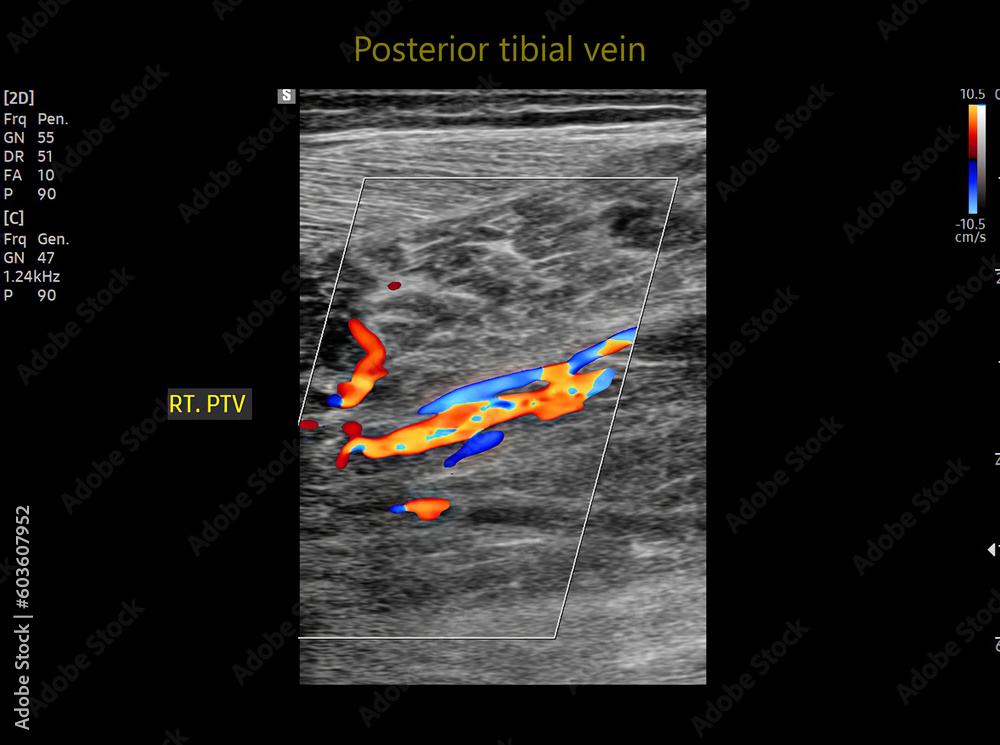 Color Doppler ultrasound determination in deep vein thrombosis patients ...