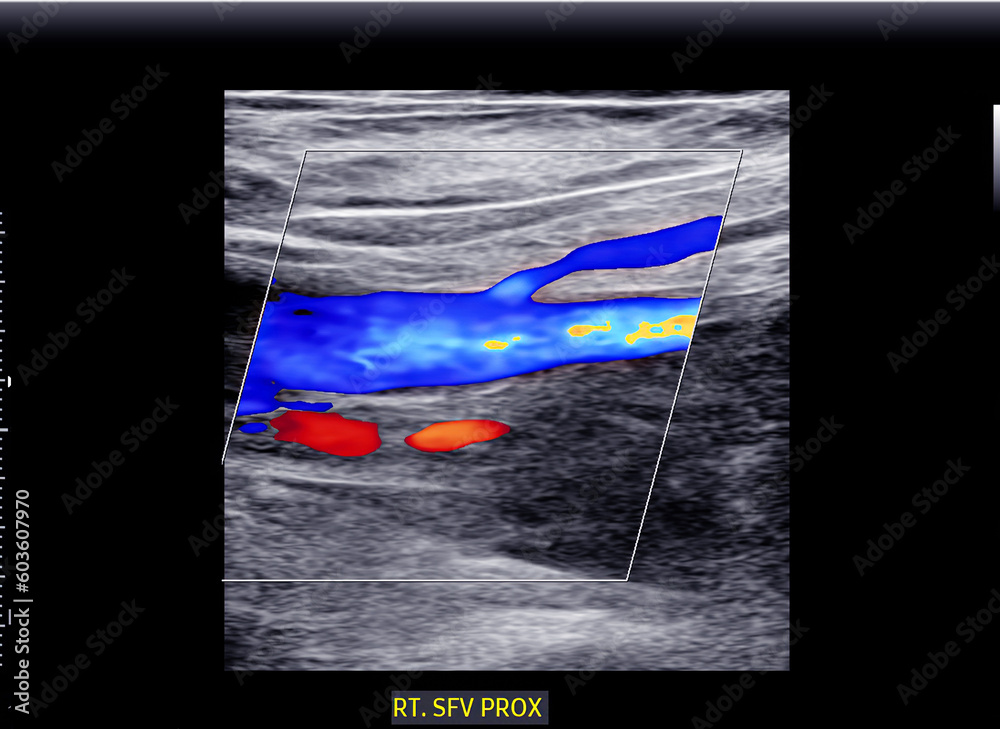 Color Doppler ultrasound determination in deep vein thrombosis patients ...