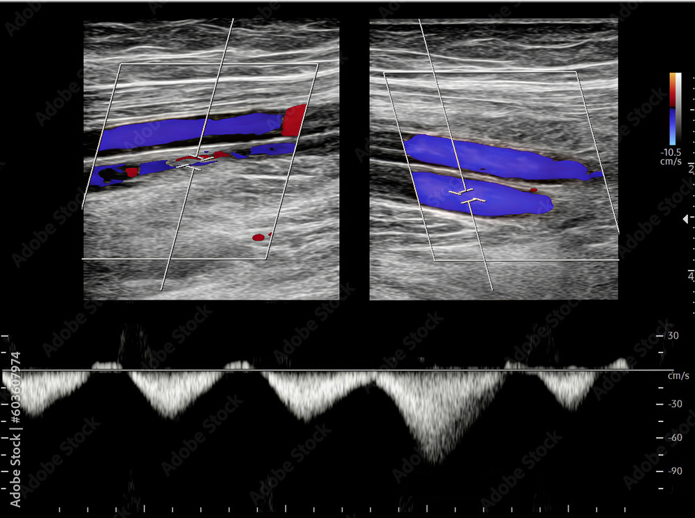 Color Doppler ultrasound determination in deep vein thrombosis patients ...