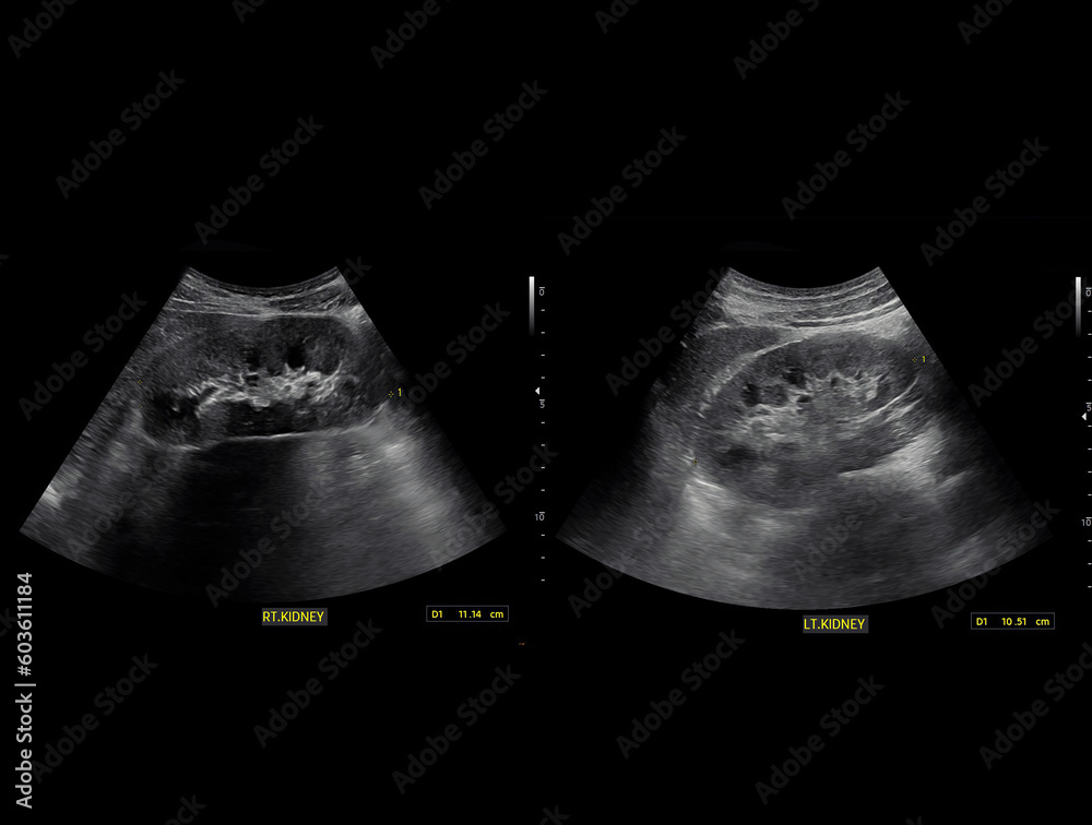 Ultrasound of Kidney or KUB for screening renal stone disease or ...