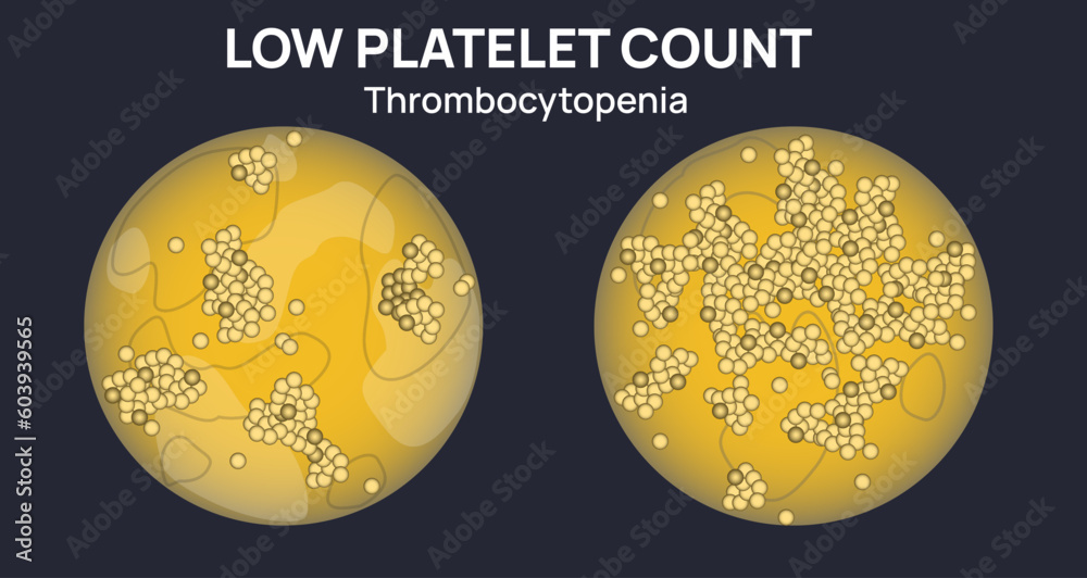 Vektorová grafika „Low platelet counts on microscope colorful view ...