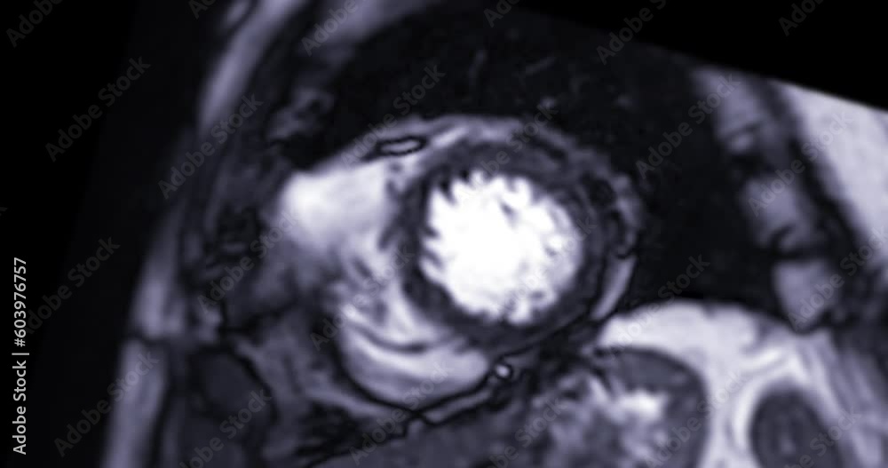 MRI heart or Cardiac MRI ( magnetic resonance imaging ) of heart ...