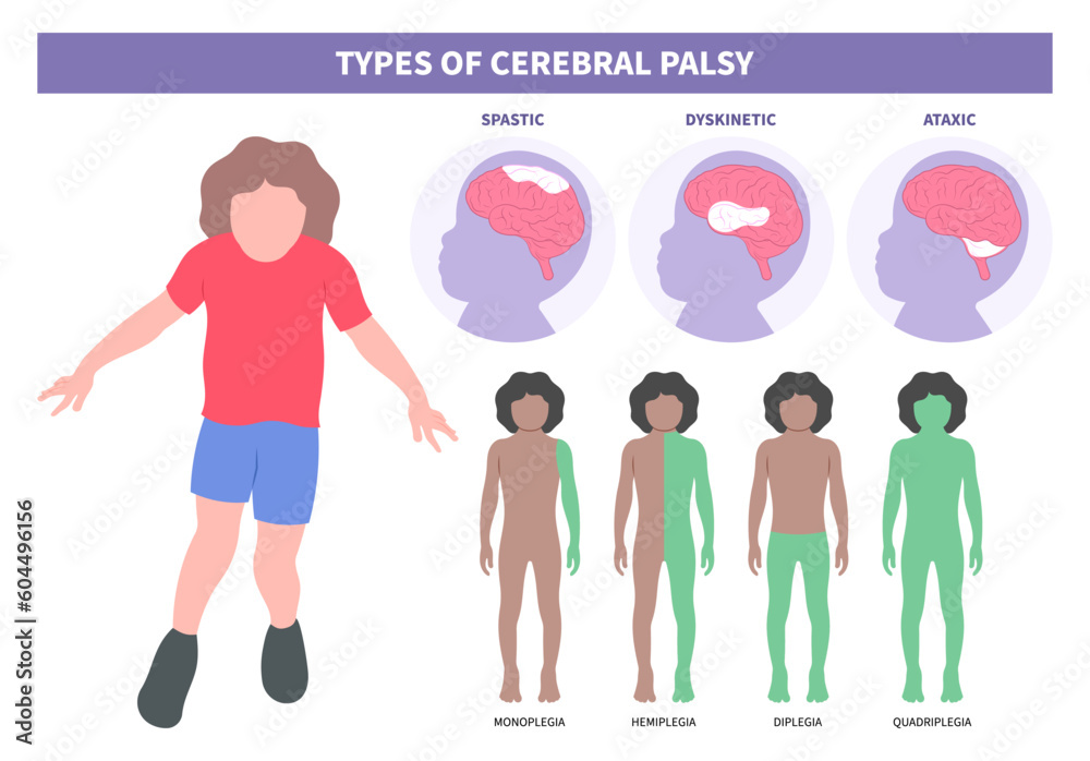 Child tremors arm leg in Monoplegia Cerebral palsy dyskinetic or ...