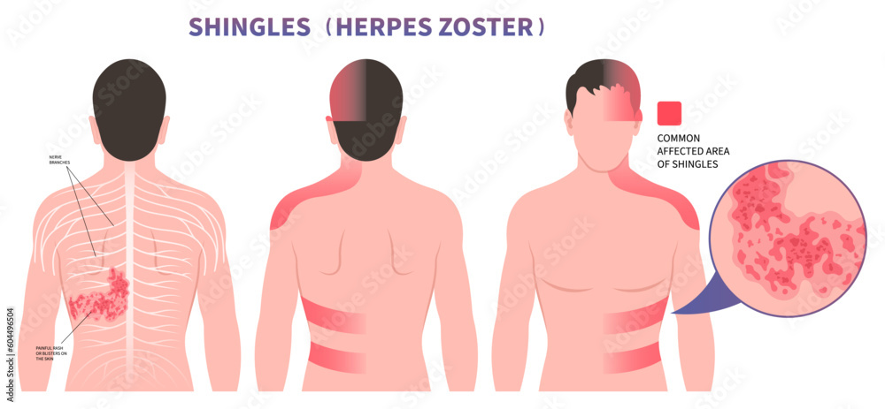 Area that the varicella chickenpox pain on body and skin itching rash Shingles Herpes Zoster ...
