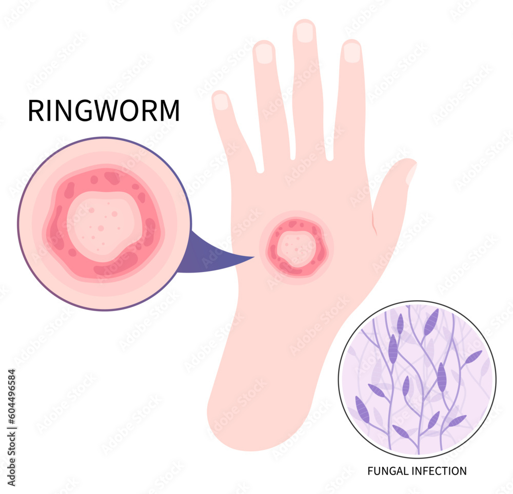 Hand with ringworm eczema psoriasis or Jock itch skin fungal rash body ...