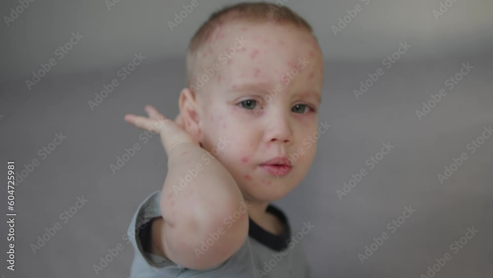 baby child little kid chicken pox disease face red pimples symptoms boy suffer from itch try to ...