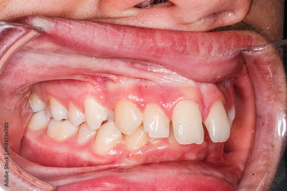 Dental maxillary and mandibular arches in occlusion with biting teeth ...