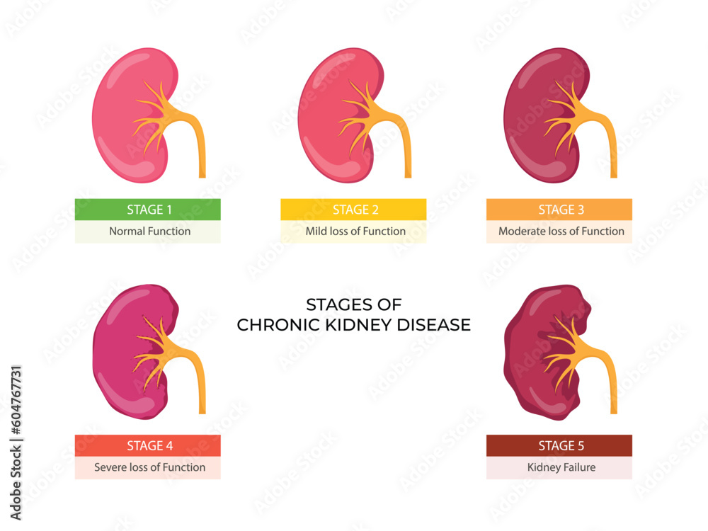 Stages of chronic kidney disease. Problem in urinary system and normal ...