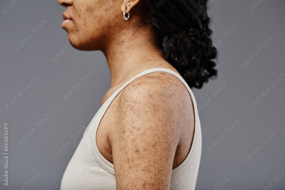 Closeup side view of black young woman with real skin texture and acne ...
