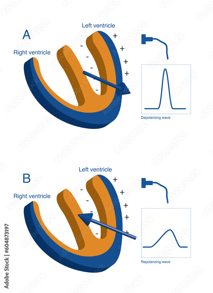 When the whole ventricle is depolarized and repolarized, the QRS wave ...
