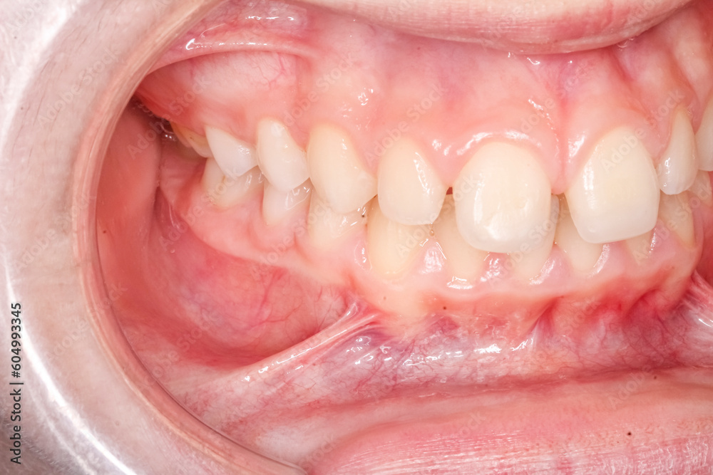 Lateral oblique view of dental maxillary and mandibular arches in ...