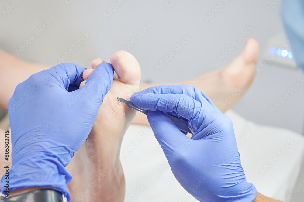 Podiatrist doctor checks the feet of a patient who needs to remove a ...