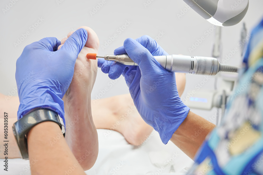 Podiatrist using a medical drill to remove a callosity (hyperkeratosis ...