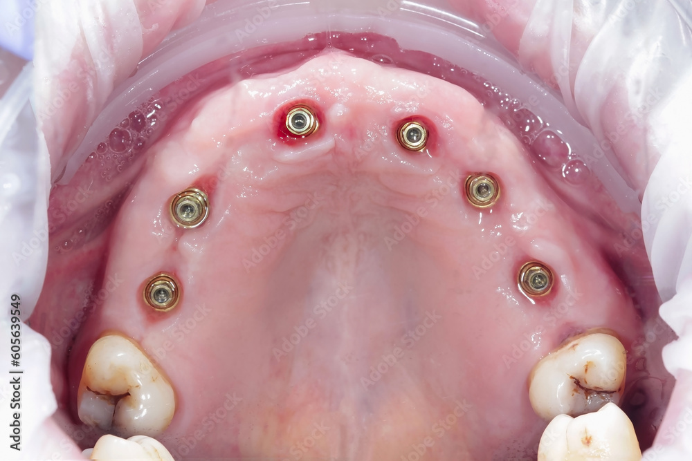 Screwed dental implants in the jaw. Concept of modern procedure in ...