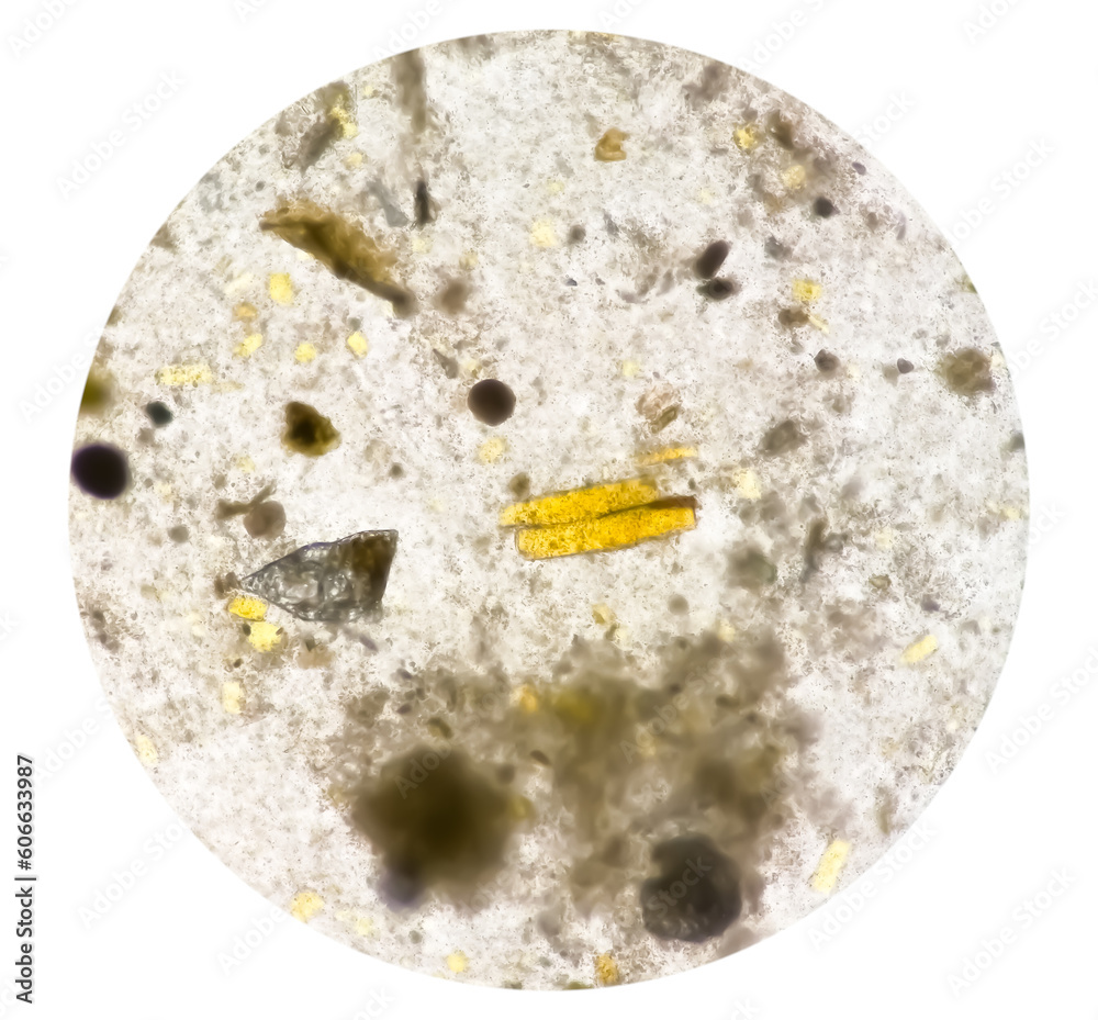 Stool analysis. Microscopic examination of human stool, abnormal report ...