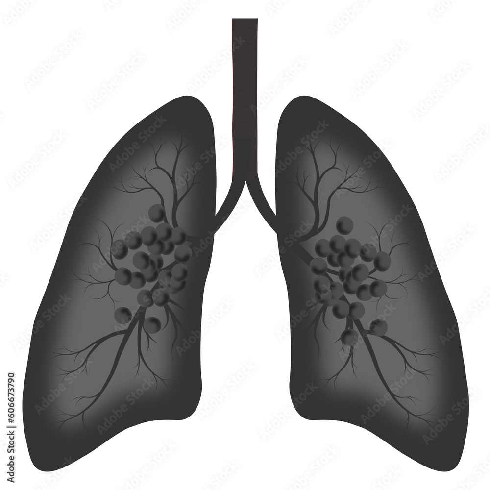 human healthy and Cancered lungs on white transparent background for ...