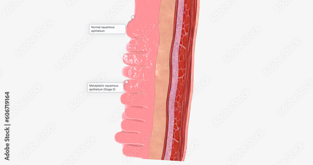 Adenocarcinoma of the esophagus results from abnormal cell mutations ...