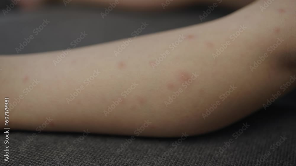 Video Stock chickenpox rash blisters filled liquid on child skin leg and body. close-up view pox ...