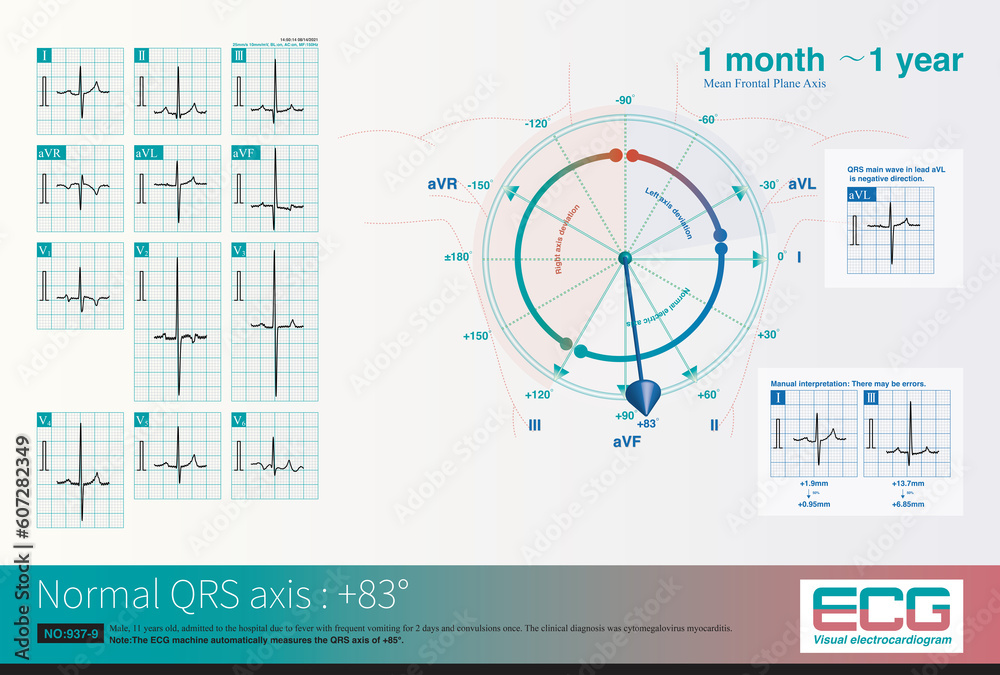 The normal frontal QRS axis in children are more right-biased than in ...