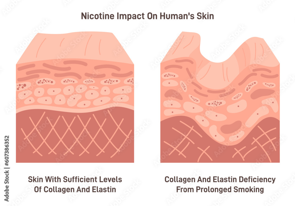 Nicotine impact on human skin. Cross section of epidermis, reduction ...
