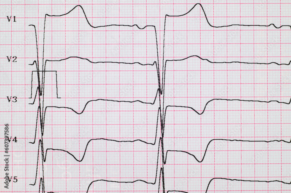 ECG. Myocardial infarction on ECG, subendocardial ischemia in chest leads. Angina. Chest pain ...