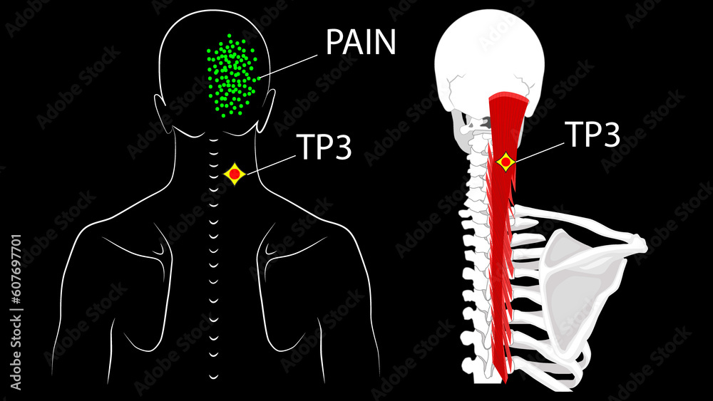 Semispinalis muscles. Trigger points and referred pain on the back of ...