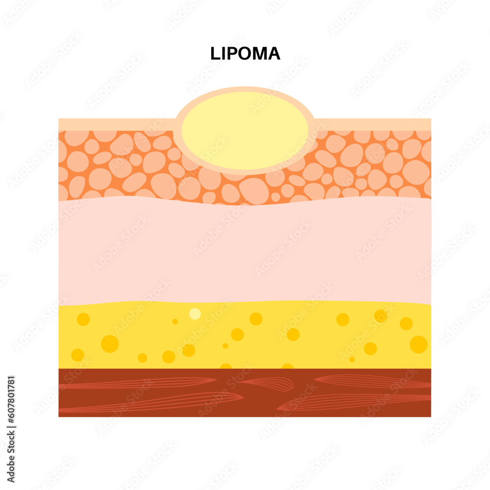 Lipoma medical poster Stock Vector | Adobe Stock