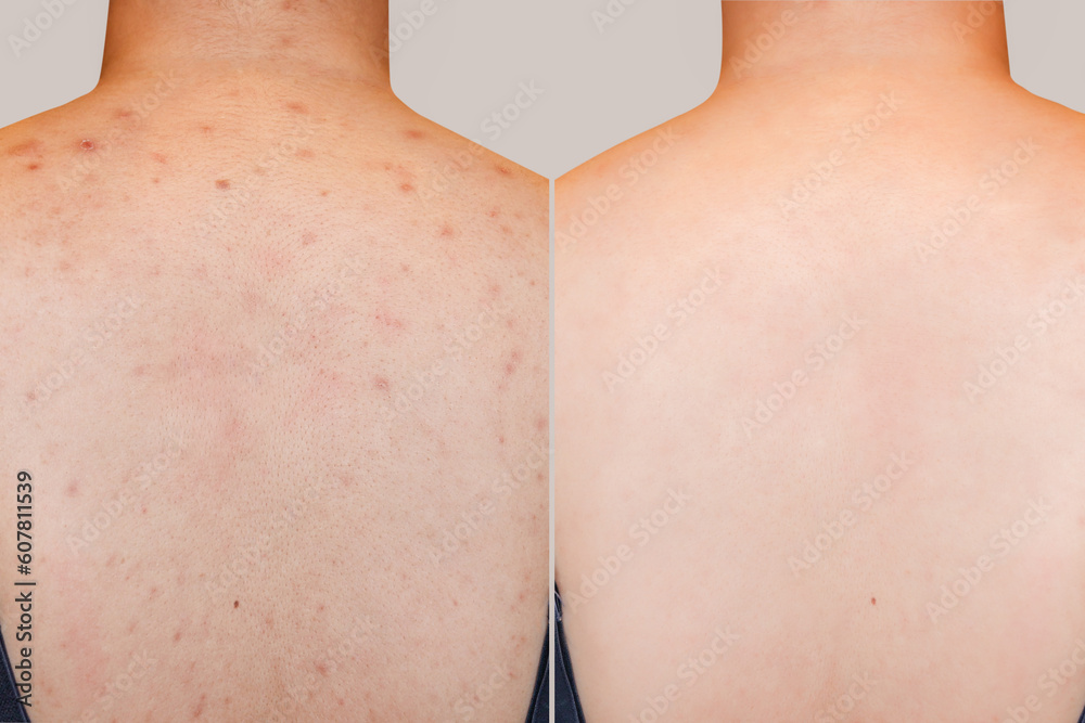 Closeup young woman's back with red rash skin and acne scar on ...