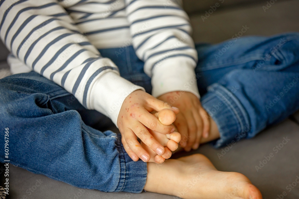 Foto de Child with skin rash, roseola. Hand-foot-and-mouth disease ...
