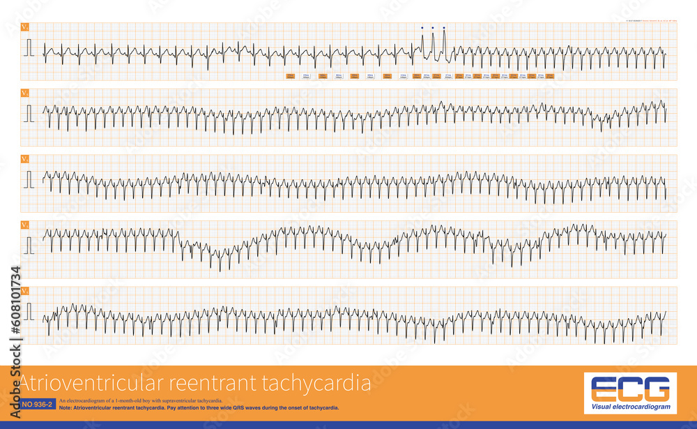 A 1-month-old child developed atrioventricular reentrant tachycardia ...