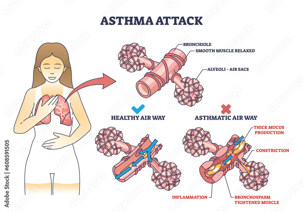 Poster Asthma attack explanation compared with healthy air way outline ...