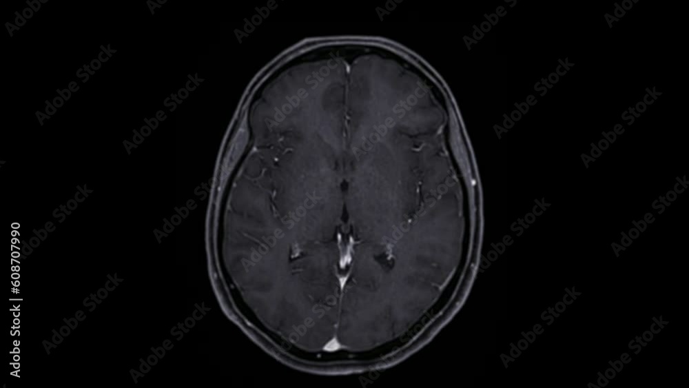 Brain MRI head scans and tumor detection black and white diagram ...