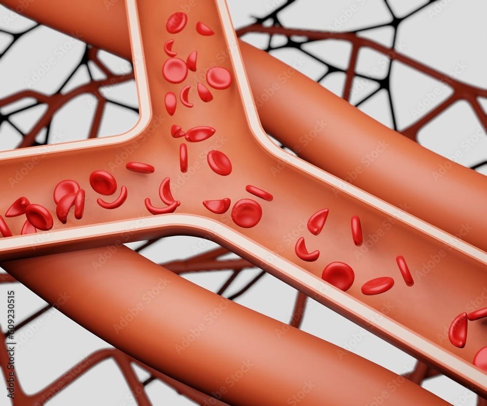 Red blood cells have crescent- or “sickle”-shaped in the capillaries ...