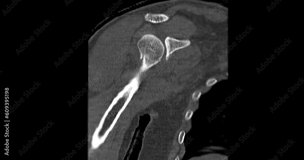 CT scan of shoulder joint Coronal view showing fracture head of humerus ...