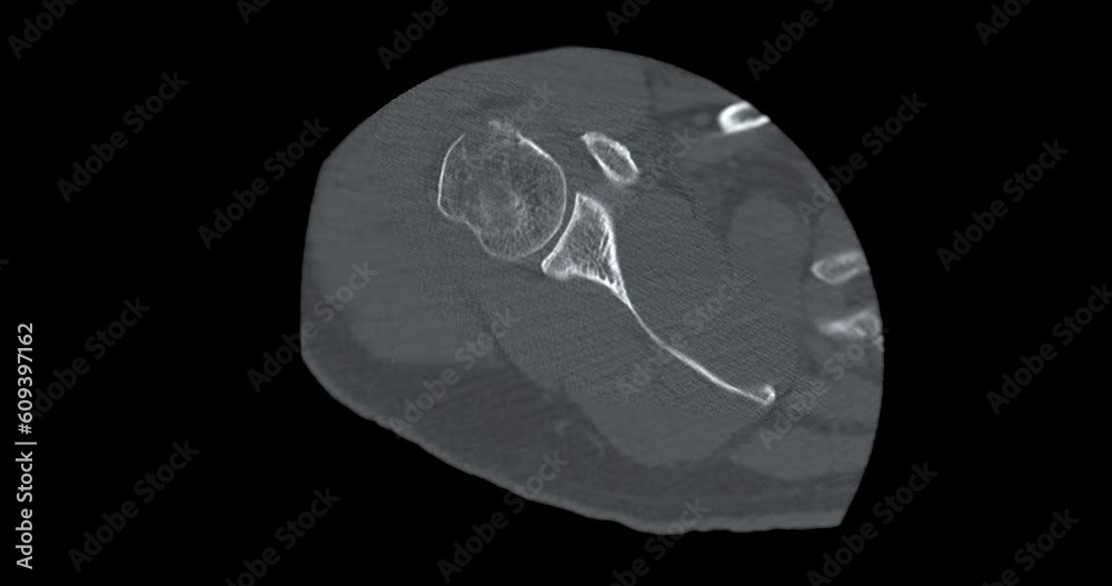CT scan of shoulder joint axial view showing fracture head of humerus ...