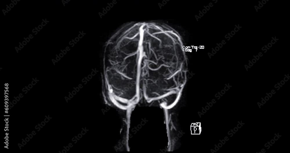 MRV Brain or MR cerebral venography for diagnostic Cerebral venous ...