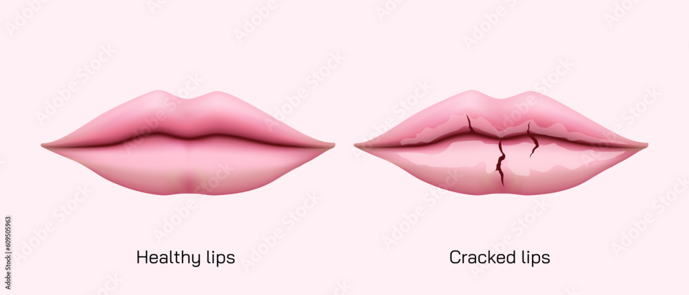 Chronic angular cheilitis problem. Dry chapped lips vector illustration ...