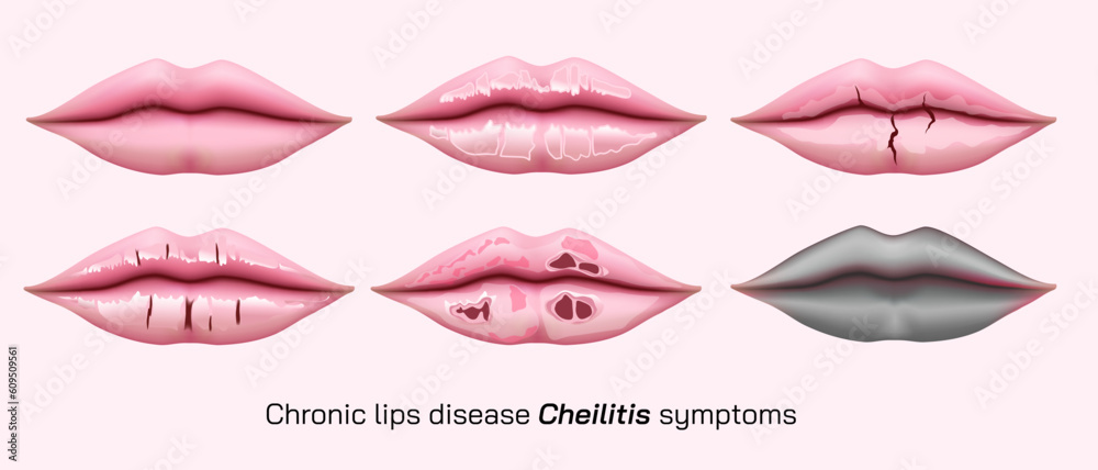 Chronic angular cheilitis problem. Dry chapped lips vector illustration ...