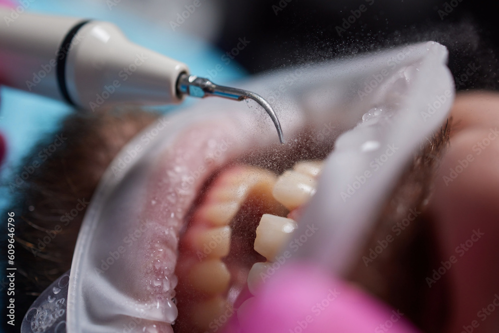 Macro photography. Top view on cleaning process in patient's mouth ...