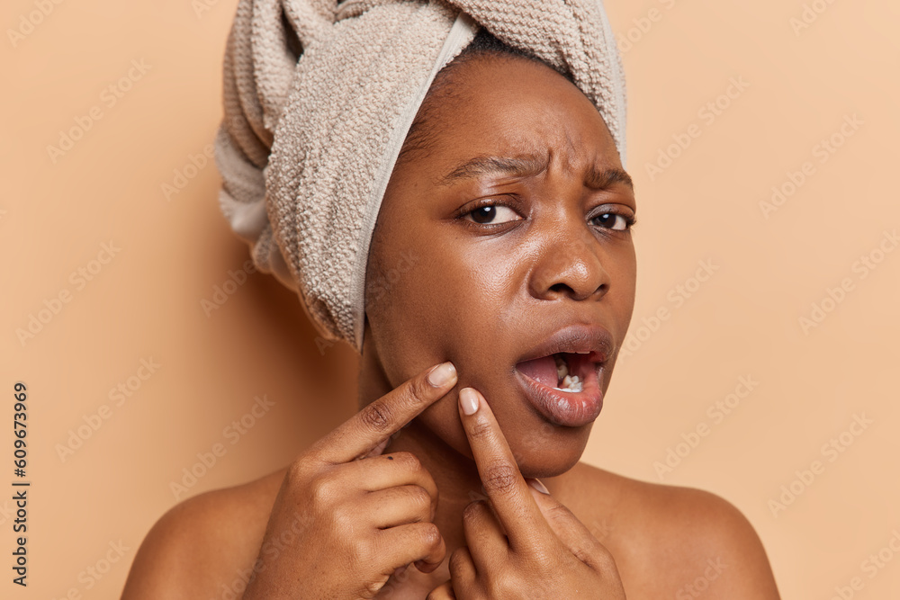 Acne treatment and beauty care concept. Dark skinned young woman ...