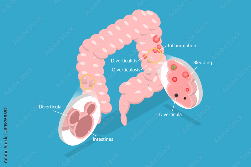 3d Isometric Flat Vector Conceptual Illustration Of Diverticulosis And