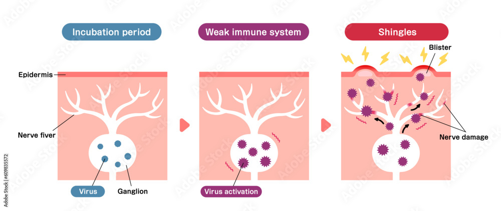 Póster Mechanism of shingles ( herpes zoster ) vector illustration ...