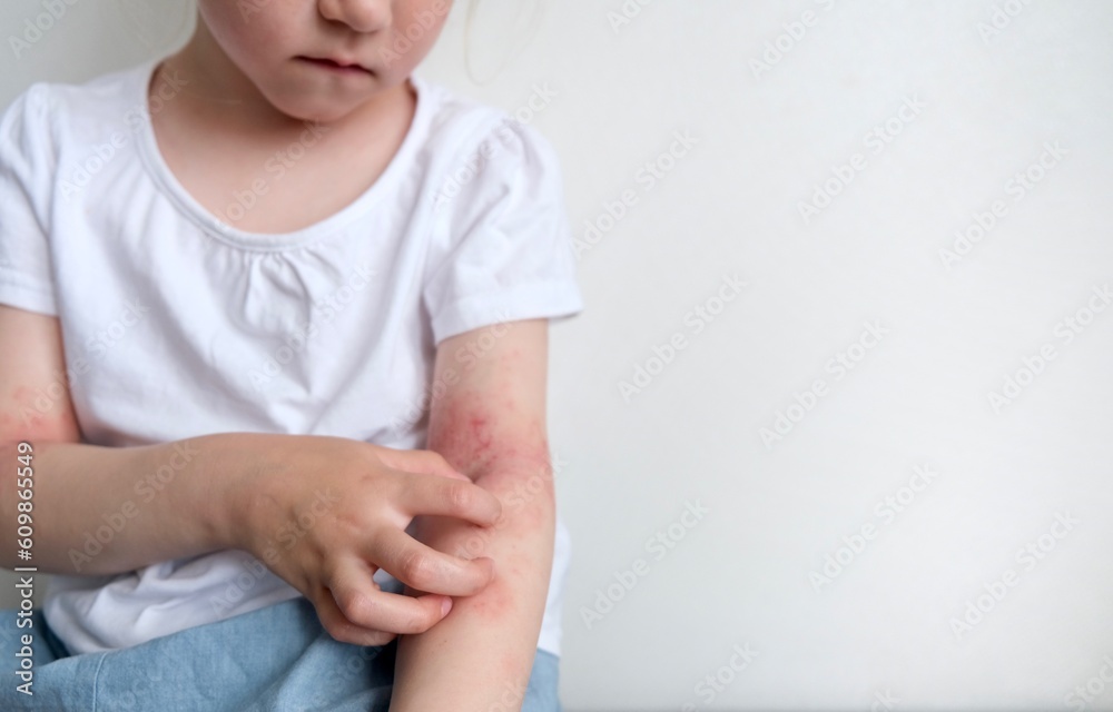 The child scratches atopic skin. Dermatitis, diathesis, allergy on the ...