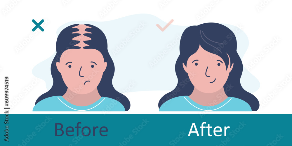 Bald woman before and after hair transplantation. Unhappy girl with ...