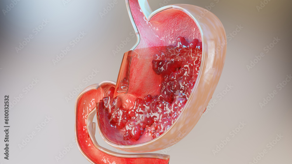 Stomach cancer. stages tumor growth in digestive system, Peptic Ulcer ...