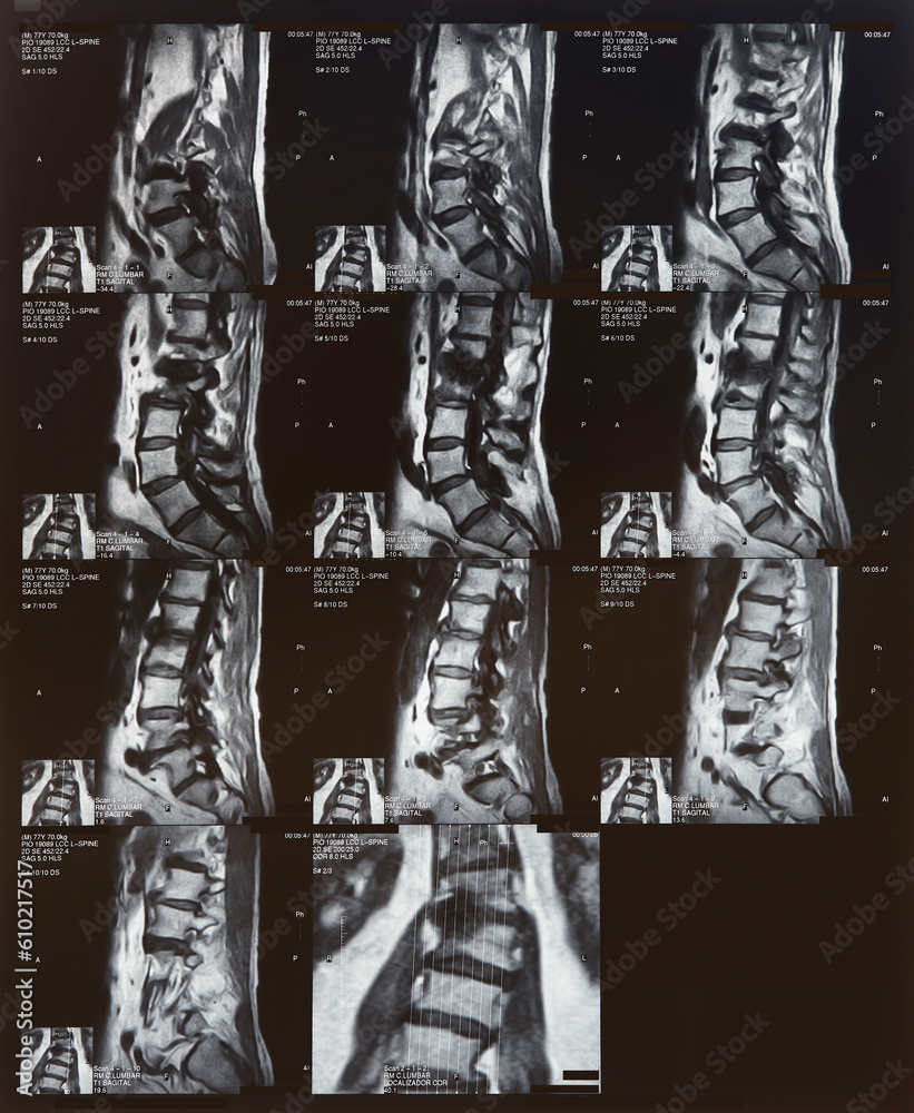 Magnetic resonance imaging. Spinal column detail. Medical procedure ...
